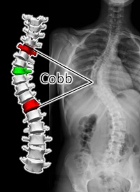 Centre Alpin de la Scoliose - CHU Grenoble Alpes